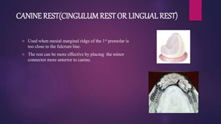 Indirect retainers | PPTX