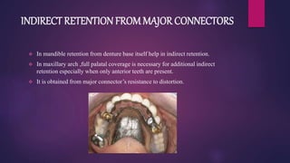 Indirect retainers | PPTX