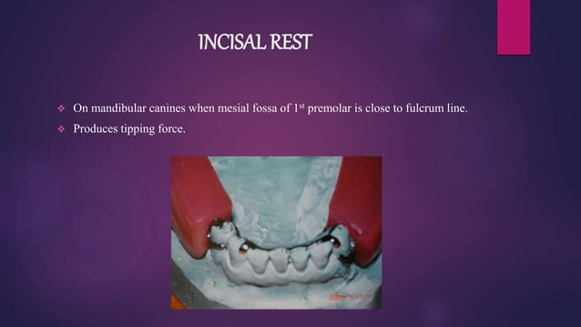 Indirect retainers | PPTX