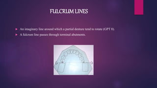 Indirect retainers | PPTX