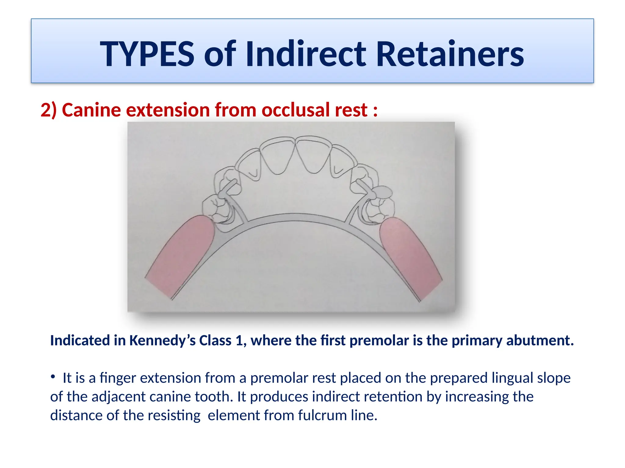 INDIRECT RETAINERS RPD Dr. Sanket Jadhav | PPTX