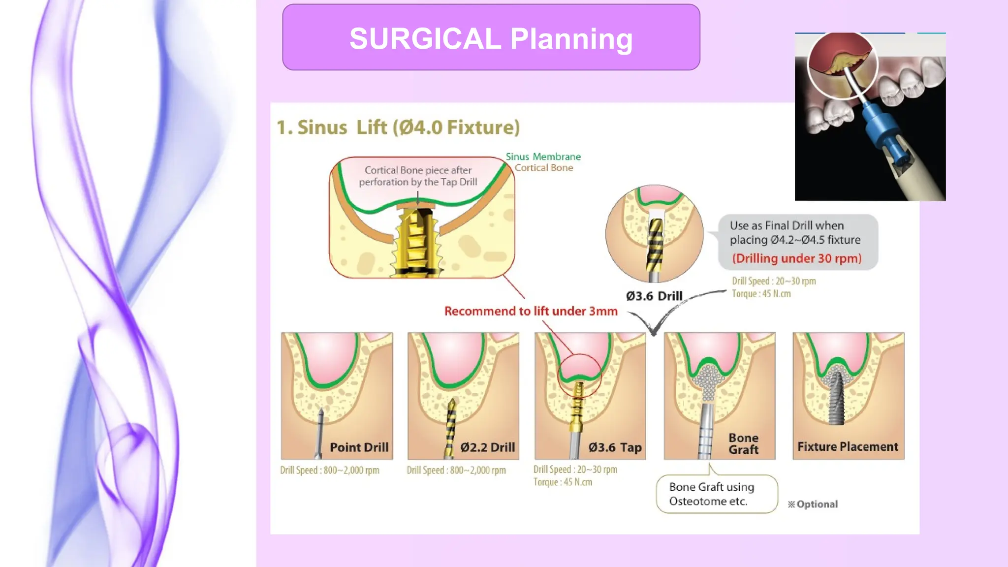 INDIRECT SINUS LIFT CASE PRESENTATION .pptx