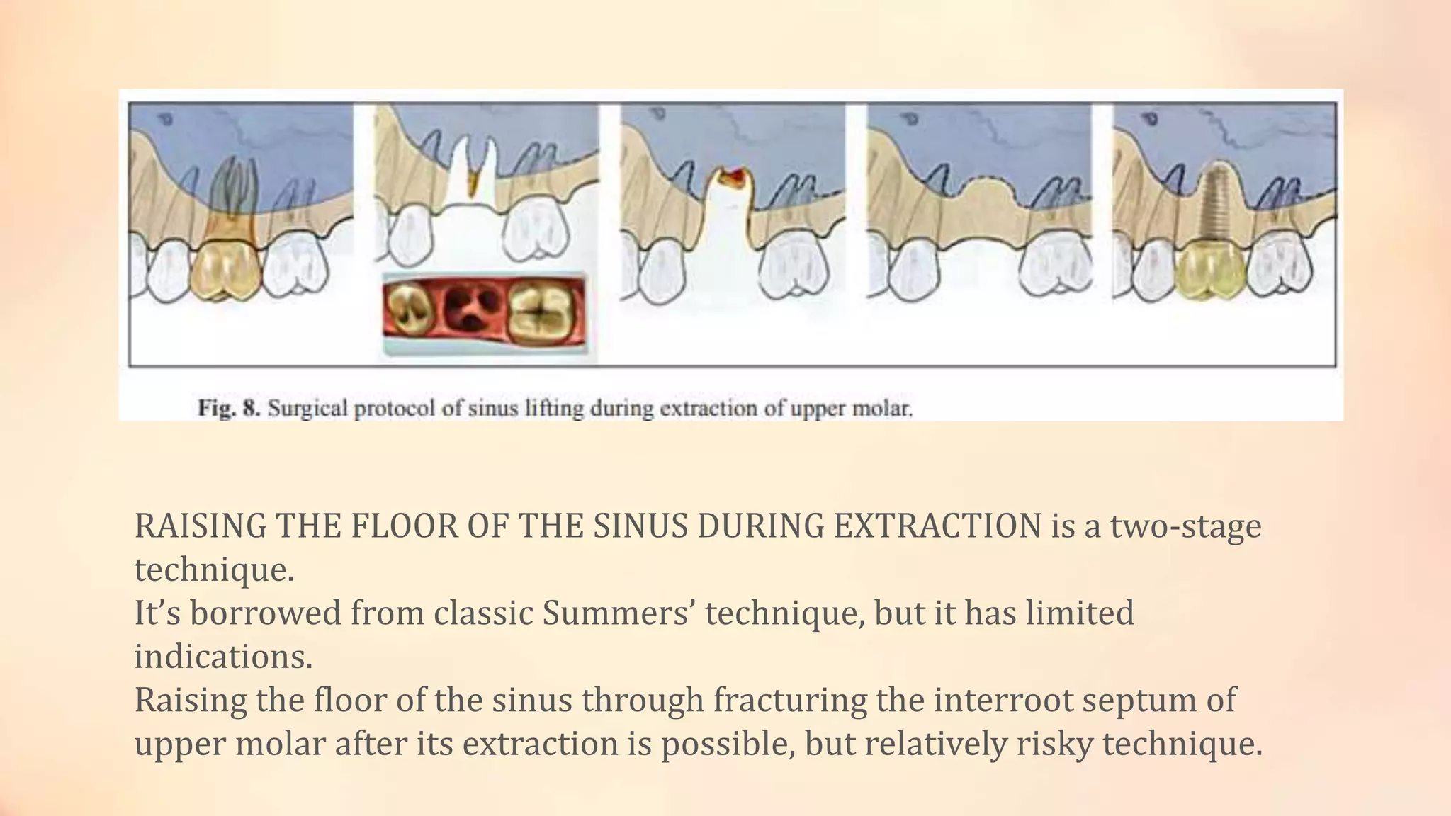 Indirect sinus lift technique | PPTX