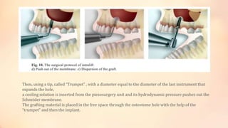 Indirect sinus lift technique | PPTX