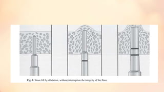 Indirect sinus lift technique | PPTX