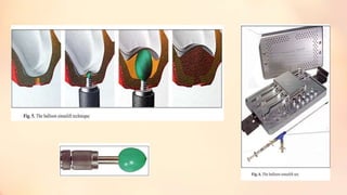 Indirect sinus lift technique | PPTX