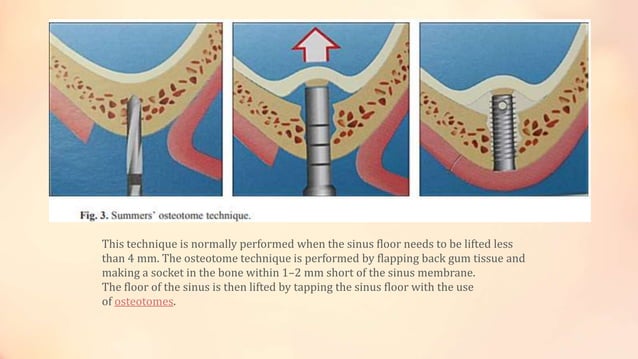 Indirect sinus lift technique | PPT