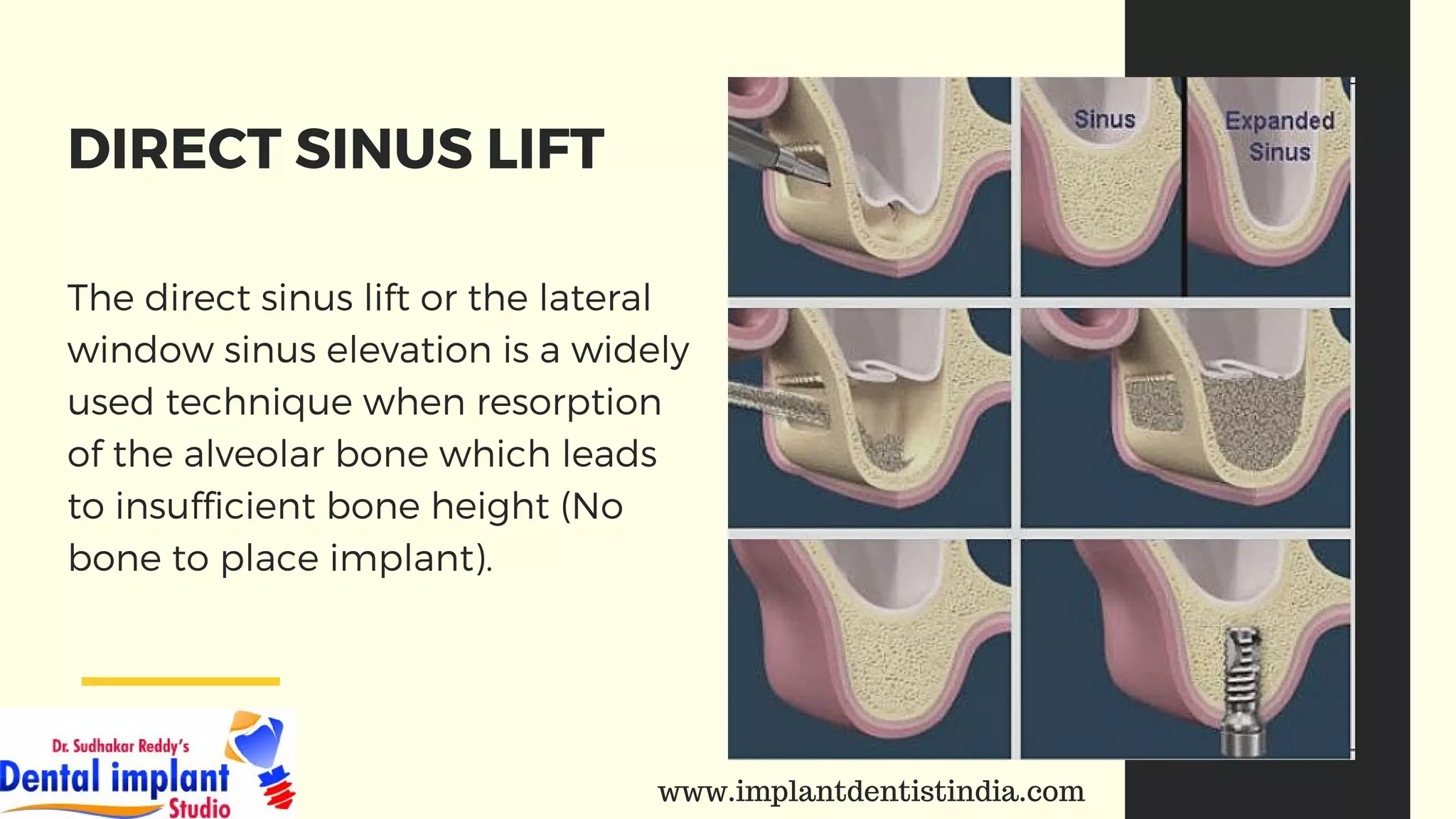 Indirect sinus lift vs Direct sinus lift | PDF