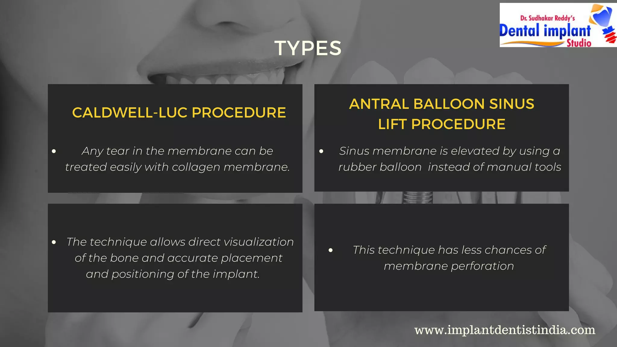 Indirect sinus lift vs Direct sinus lift | PDF