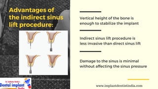 Indirect sinus lift vs Direct sinus lift | PDF