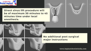 Indirect sinus lift vs Direct sinus lift | PDF