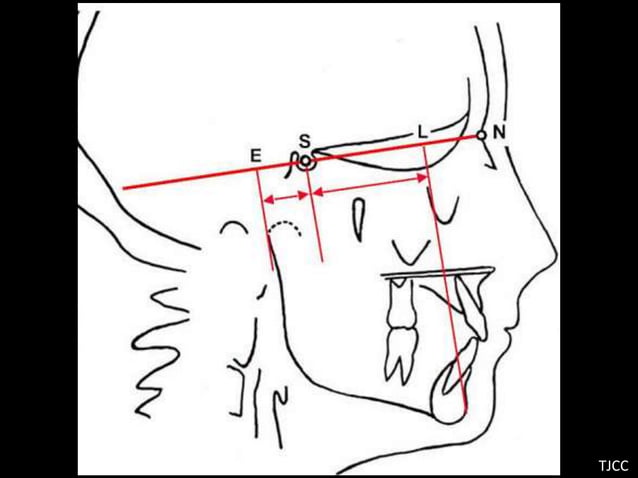 Analisis Ortodoncia. Individualizado de Steiner. Steiner. | PPTX