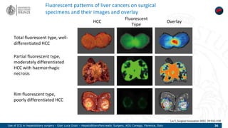 Indocyanine green (ICG) in liver surgery.pptx