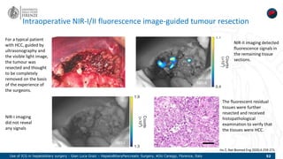 Indocyanine green (ICG) in liver surgery.pptx