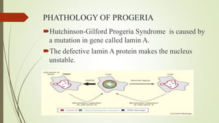 PROGERIA | PPT