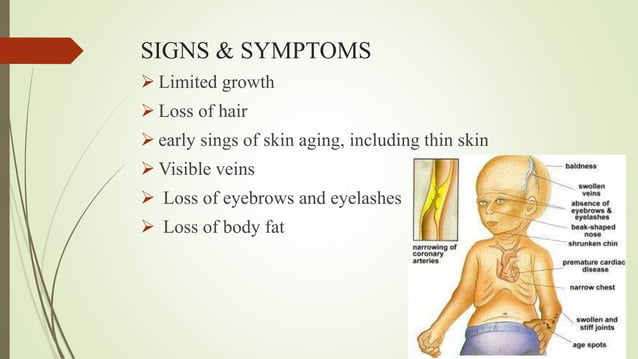PROGERIA | PPT