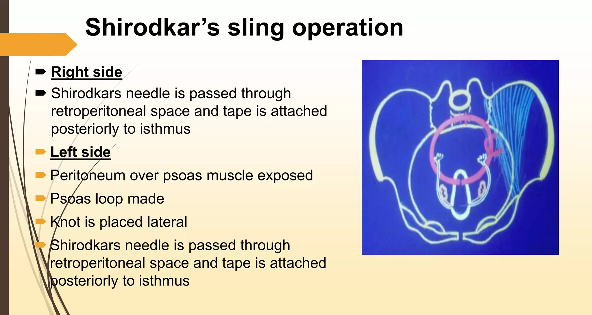 Classification & conservative surgeries for prolapse | PPTX