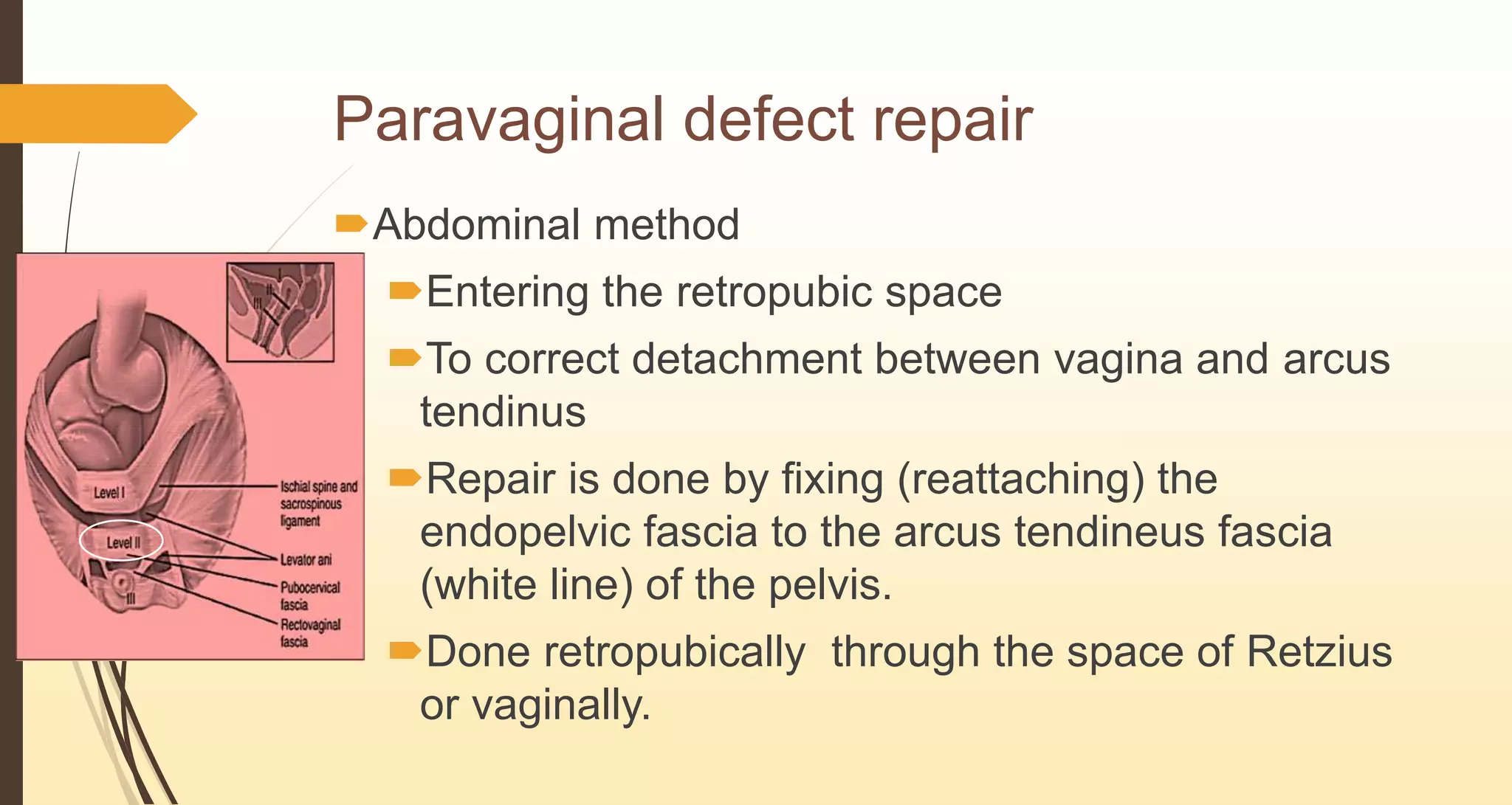 Classification & conservative surgeries for prolapse | PPTX