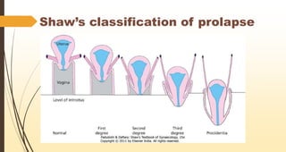 Classification & conservative surgeries for prolapse | PPTX