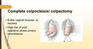 Classification & conservative surgeries for prolapse | PPT