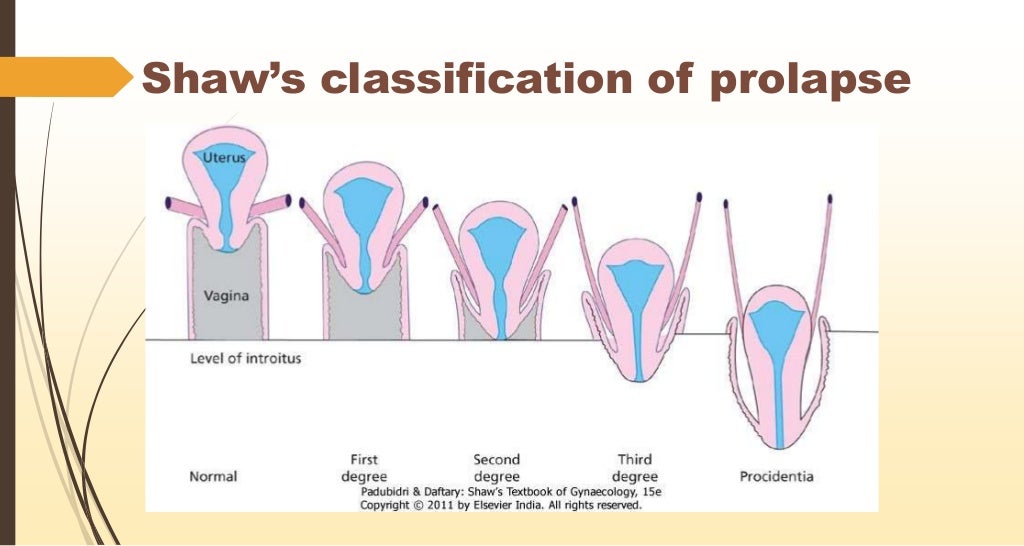 Classification & conservative surgeries for prolapse