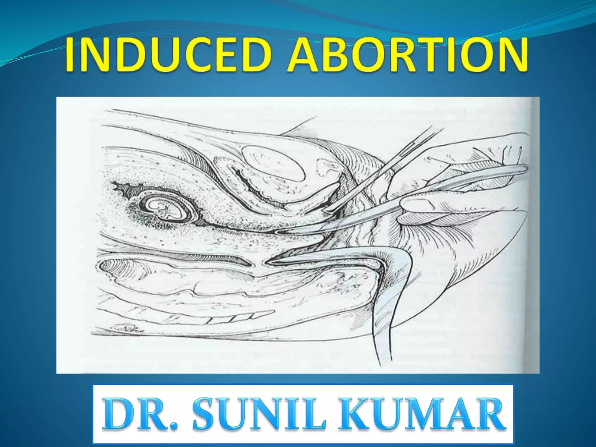 Induced abortion | PPTX