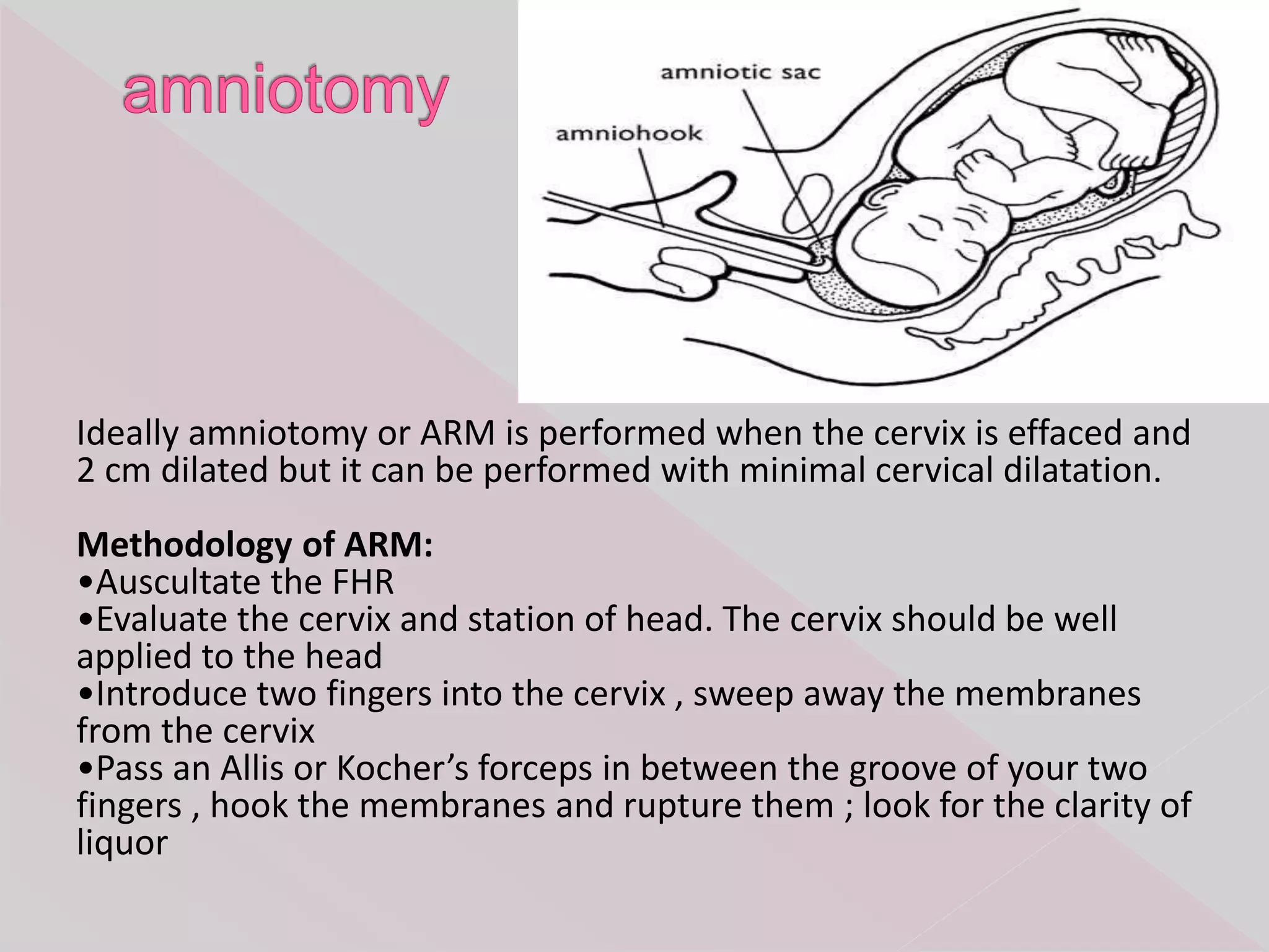 Induction of labour | PPTX