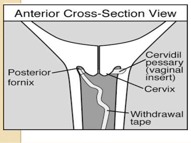 Induction of labour (2)