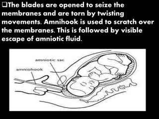 Induction of labour ppt | PPTX