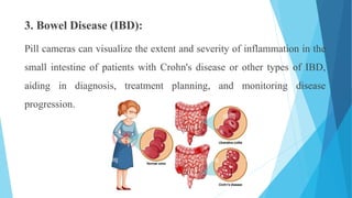 PILL CAMERA IN THE MEDICINE it helps to the health condition | PPT