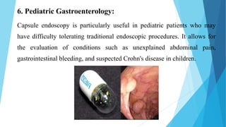 PILL CAMERA IN THE MEDICINE it helps to the health condition | PPT