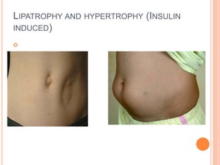 Inectables of diabetes | PPTX | Endocrine and Metabolic Diseases ...