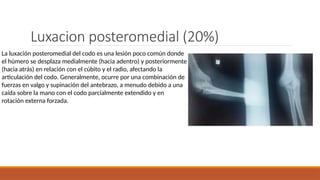 Inestabilidad y luxacion de codo traumatologia | PPTX