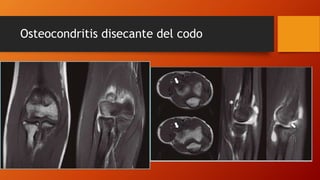 inestabilidad de codo.pptx