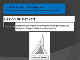 Inestabilidad del hombro y lesiones de labrum | PPTX