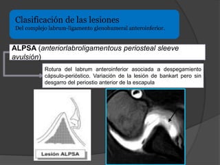 Inestabilidad del hombro y lesiones de labrum | PPTX