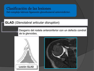Inestabilidad del hombro y lesiones de labrum | PPTX