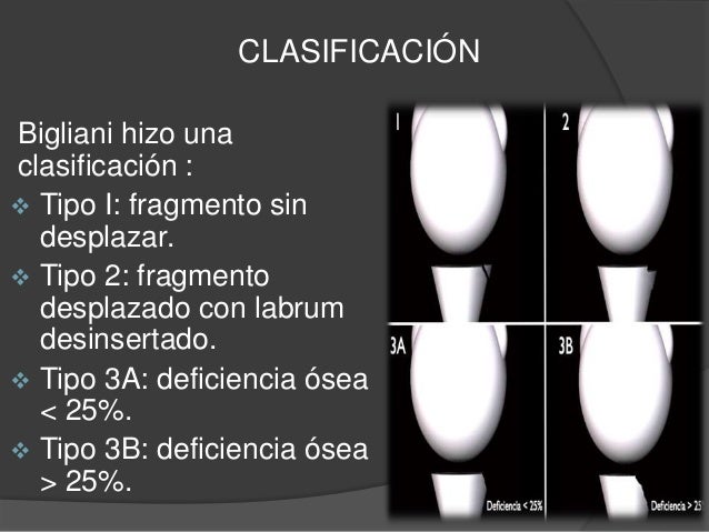 Inestabilidad del hombro y lesiones de labrum