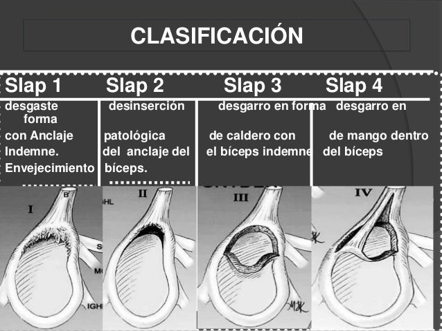 Lesiones De Hombro Lesion Del Supraespinoso Y Lesion De Slap Superior ...