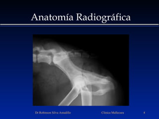 Inestabilidad Lumbosacral | PPT