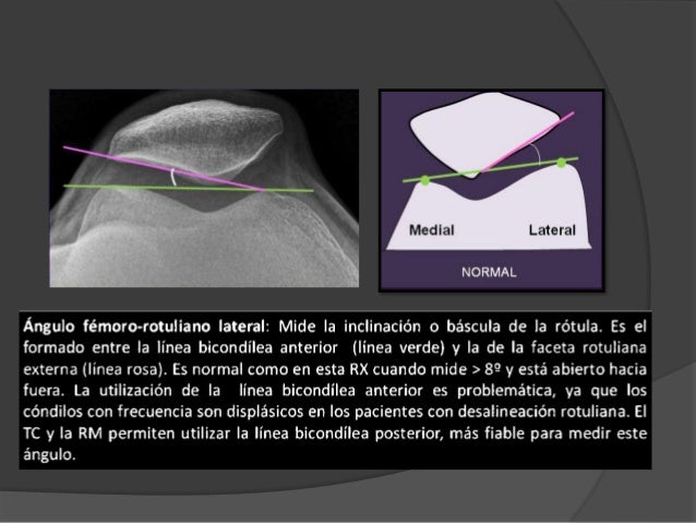 Inestabilidad patelofemoral