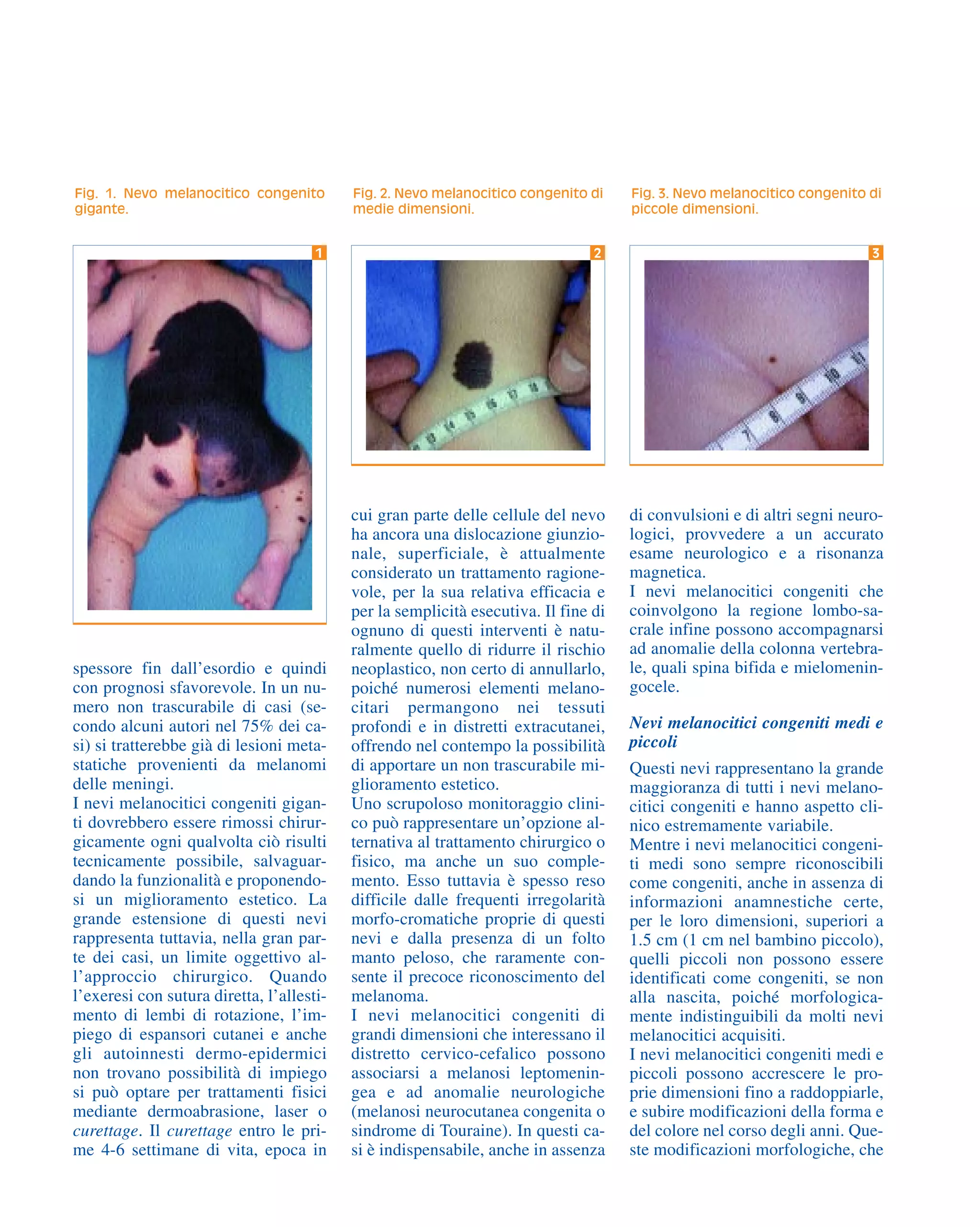 I nevi melanocitici_in_pediatria | PDF