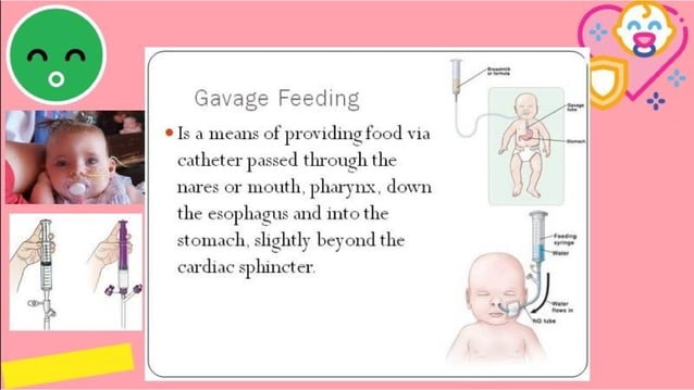 INFANT GAVGE FEEDING 2021 PowerPoint Presentation | PPTX