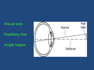 Infantile esotropia by dr adnan | PPTX