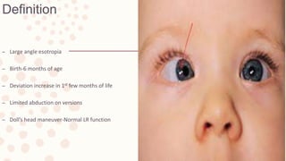 Infantile esotropia | PPTX