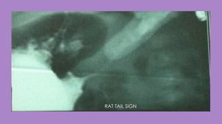 Infantile hypertrophic pyloric stenosis | PPTX