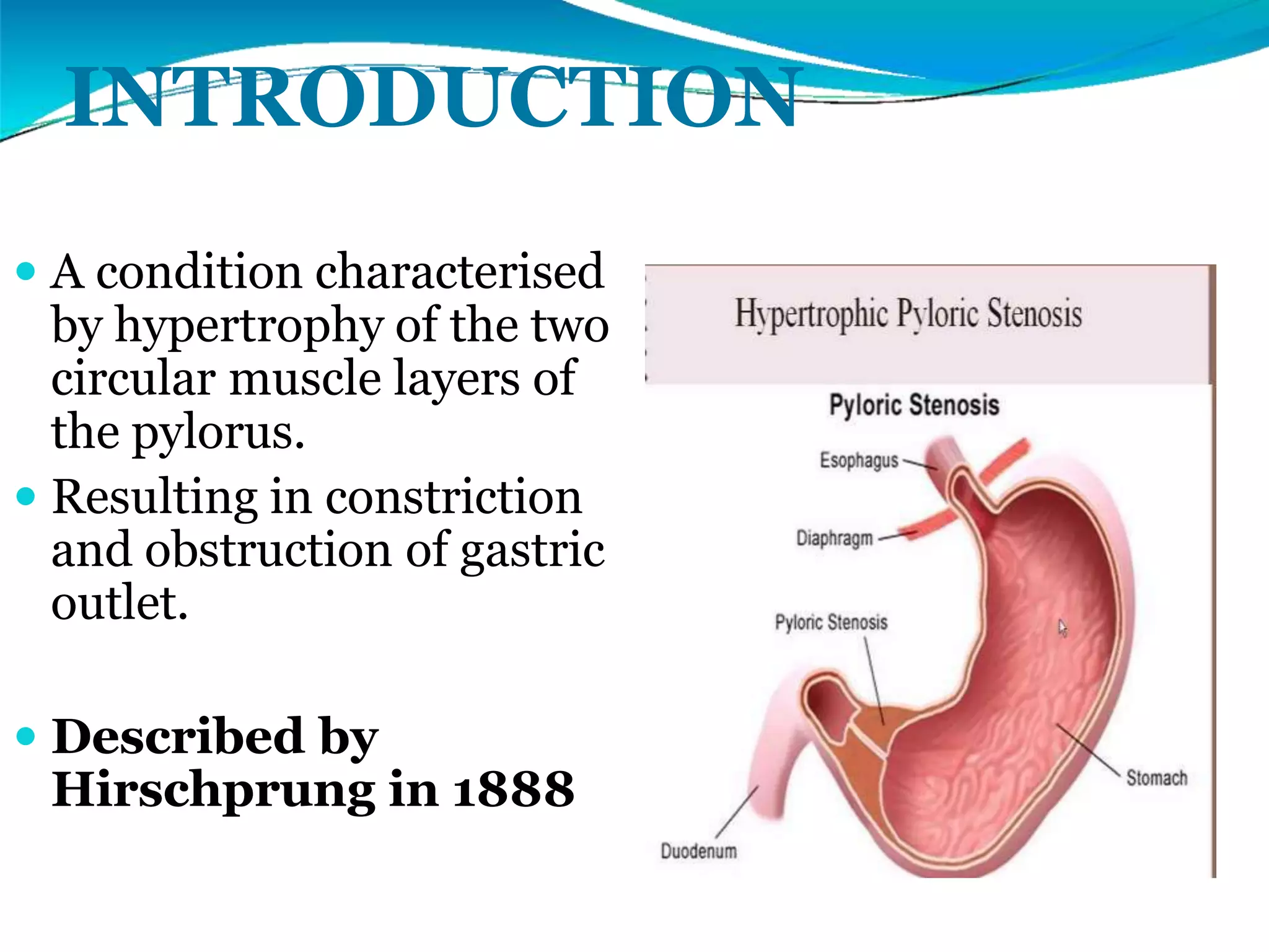 Infantile hypertrophic pyloric stenosis | PPTX
