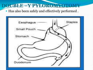 Infantile hypertrophic pyloric stenosis | PPTX