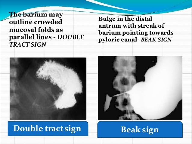 Infantile Hypertrophic Pyloric Stenosis
