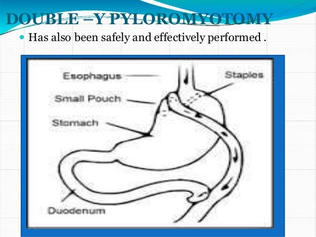 Infantile hypertrophic pyloric stenosis